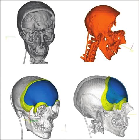 Craniofacial Computed Tomography With Three Dimensional Reconstruction Download Scientific