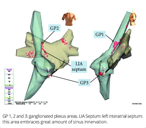 Typical Electroanatomic Mapping At The End Of A Regular Cna Not Edited Download Scientific