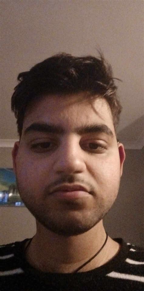 Will I Benefit From Jawsurgery Class 3 To Fix My Lower Protrusion R Plasticsurgery