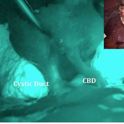 Use Of Icg Enhanced Fluorescence During Laparoscopic Cholecystectomy