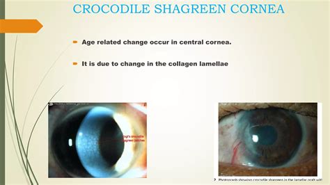 Structural Cnanges In The Eyes By Rb Pptx