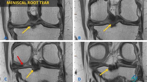 Meniscal Root Tears Posterior Horn Meniscus Part 2 Radiology