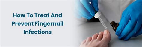 Fingernail Infection Causes Treatment And Prevention Guide