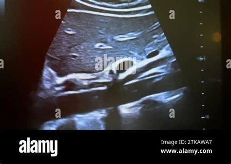 Utrasound Image On The Monitor Close Up Ultrasound Scan Display Screening Ultrasonography