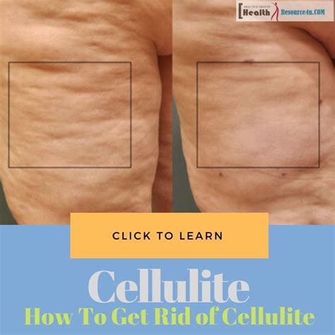 How To Get Rid Of Cellulite Causes And Treatment