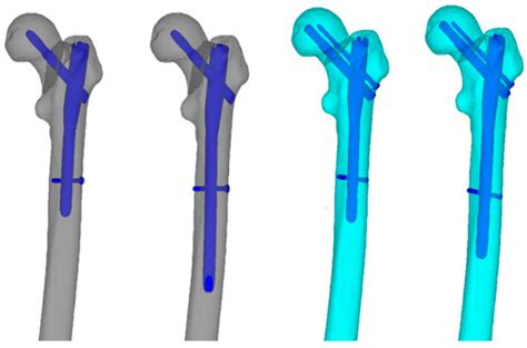 Characteristics And Treatment Strategies For Basicervical And Transcervical Shear Fractures Of