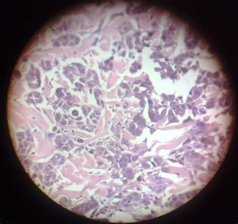 Resection Of Recurrent Retroperitoneal Sarcoma Linked To Improved Survival Cancer Therapy Advisor