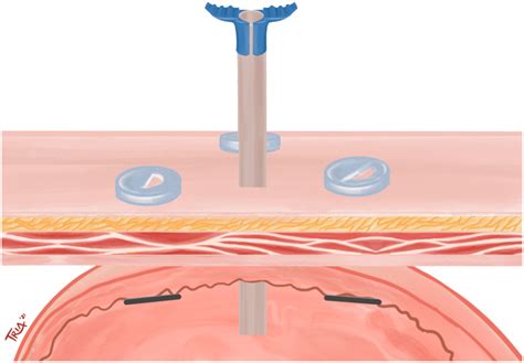 Deconstructing The Steps Of Peg Tube Insertion Using The Introducer