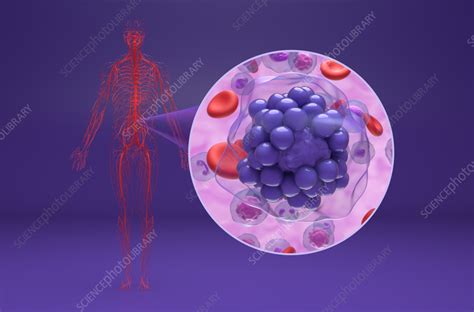 Diffuse Large B Cell Lymphoma Illustration Stock Image F043 8320 Science Photo Library