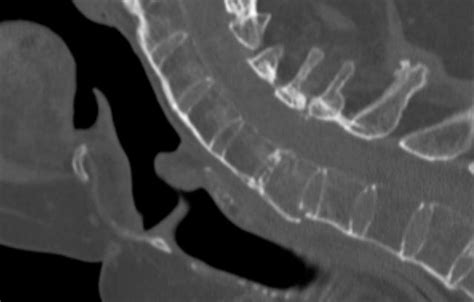 ¿qué Es La Espondilitis Anquilosante Geer Sociedad Para El Estudio