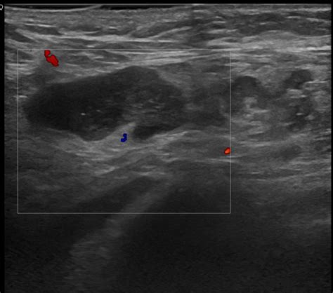 Unilateral Axillary Lymphadenopathy A Rare Presentation Of