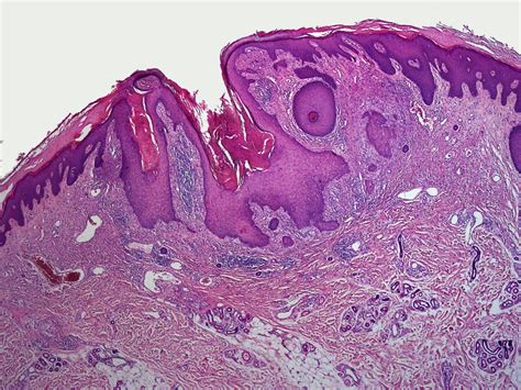 Dilated Pore Of Winer