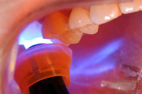 Light Curing Tip Placement And Curing Effectiveness Lee Ann Brady Dmd