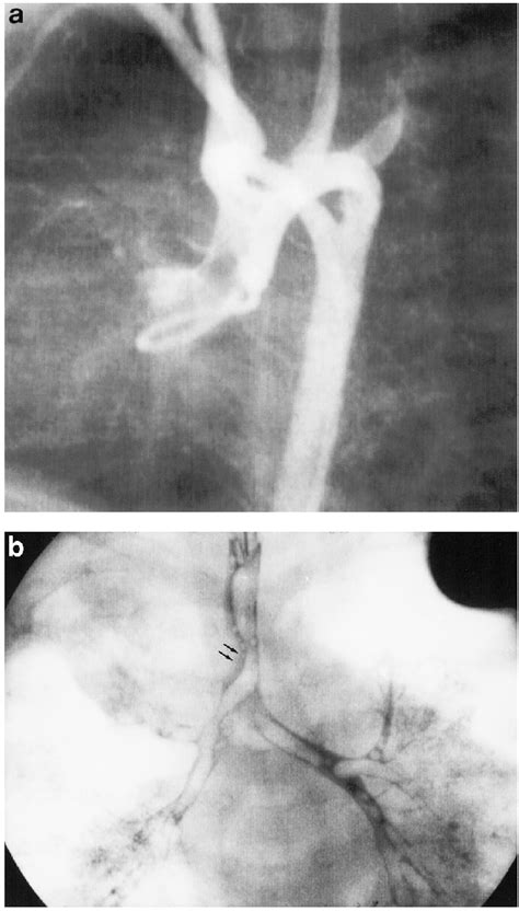 Double Aortic Arch Causing Pulsatile Compression Of The Distal Trachea Download Scientific