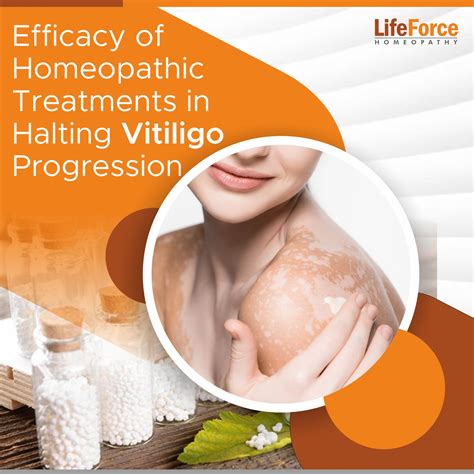 Vitiligo Treatment Halting Progression With Homeopathy Blog