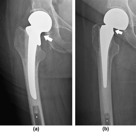 Hip Arthroplasty Part 1 Prosthesis Terminology And Classification