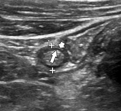 Lymphoid Hyperplasia Of The Appendix A Potential Pitfall In The