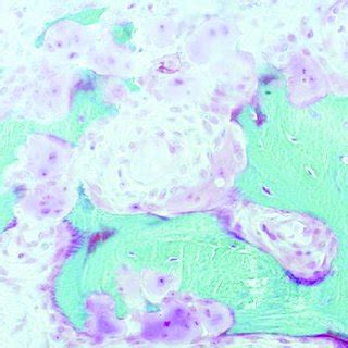 Pdf The Gorham Stout Syndrome Gorhams Massive Osteolysis A Report