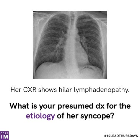 40f With Chronic Dry Cough Presents With Syncope Core Im Podcast