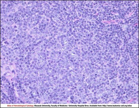 Follicular Lymphoma Cell Atlas Of Haematological Cytology