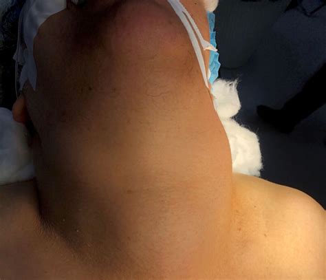 Large Toxic Multinodular Goitertotal Thyroidectomy Jun 2021 Dr