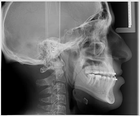 Need Surgery Advice Class Lll And Asymmetric Mandible Whatre Your Thoughts About My Airway