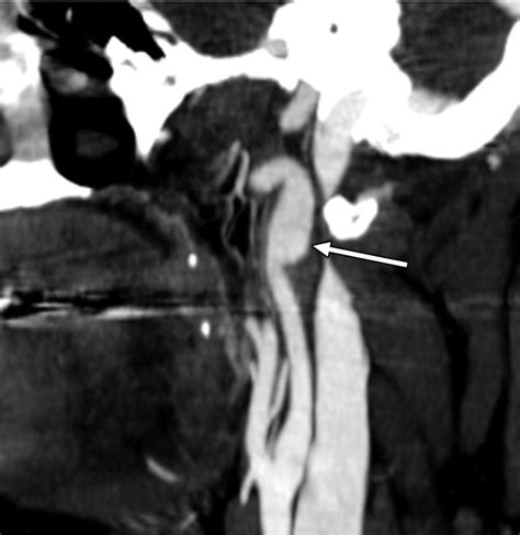 Imaging Of Blunt Vascular Neck Injuries A Clinical Perspective Ajr