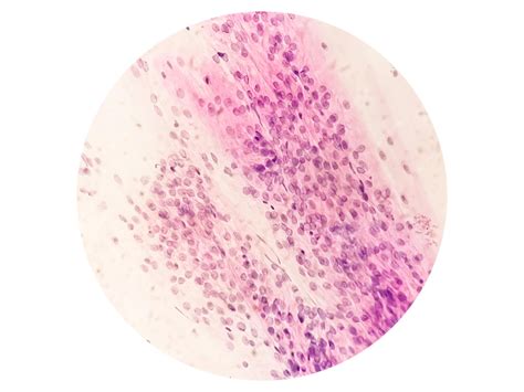 Premium Photo Trichomonas Vaginalis In Pap Smear With Few Acute