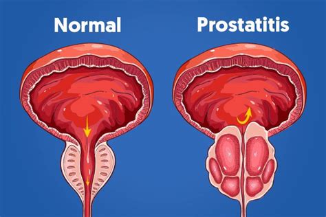 Prostatitis Qué Es Síntomas Y Tratamiento Tua Saúde