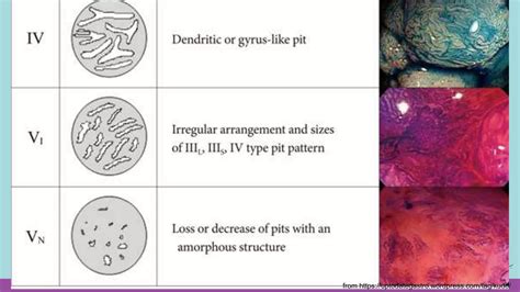 Kudos To You Learning Your Kudo Pit Patterns And Paris Polyp Classifications Pptx