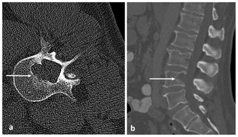 Primary Benign Neoplasms Of The Spine