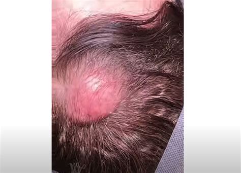 Unicorn Horn Sebaceous Cyst Drainage New Pimple Popping Videos