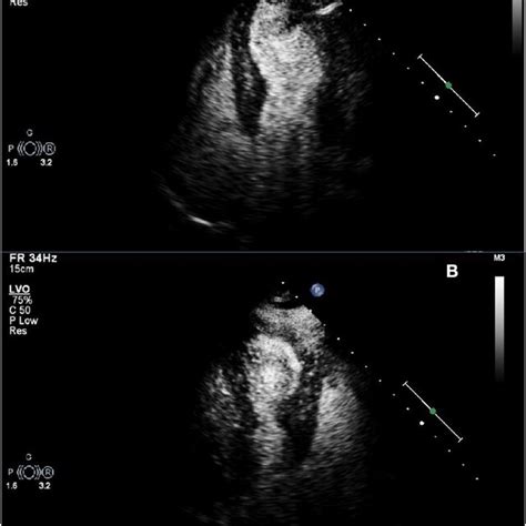 A B Transthoracic Echocardiogram With Definity Contrast Demonstrating Download Scientific