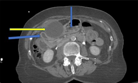 Ct Abdomen And Pelvis In The Axial View Showing A Largely Distended