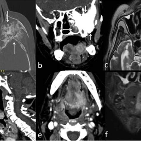 Pdf Radiation Induced Maxillary Osteosarcoma And Synchronous