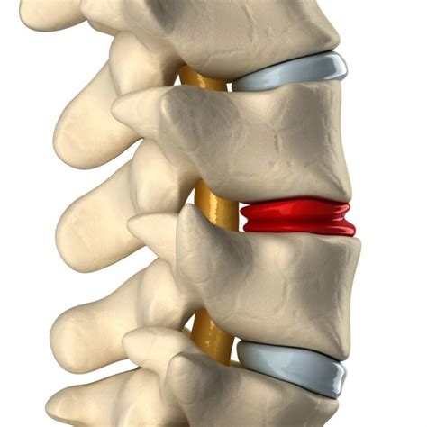 Thoracic Spine Surgery Eveything You Need To Know