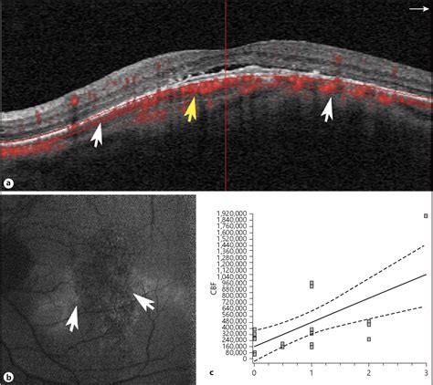 Figure 5 From Serous Retinal Detachment In Dome Shaped Macula Is