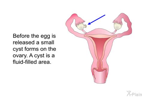 PatEdu Com Ovarian Cysts