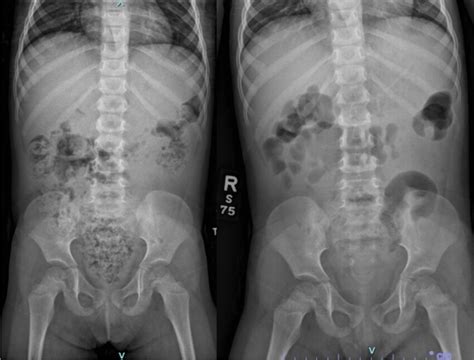 Patient With Idiopathic Constipation During Bowel Management With