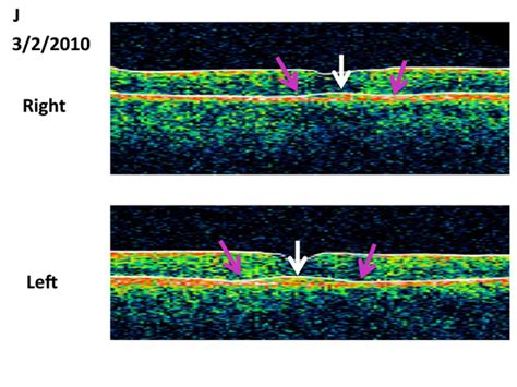 Time Domain Oct In Hydroxychloroquine Plaquenil Toxicity The Retina