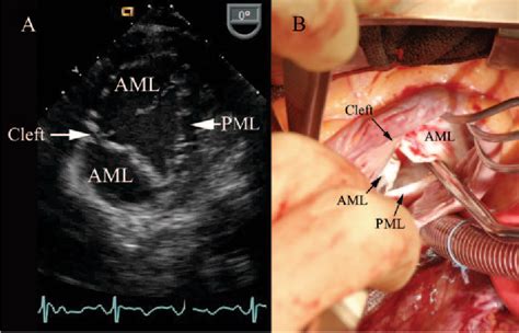 Transitional Av Canal Defect