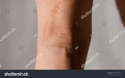 20 Imágenes De Eczema On Back Knees Imágenes Fotos Y Vectores De
