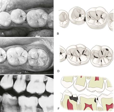 2 Dental Caries Etiology Clinical Characteristics Risk Assessment And Management Pocket
