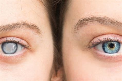 Polychromatic Cataract Signs Causes Diagnosis Treatment
