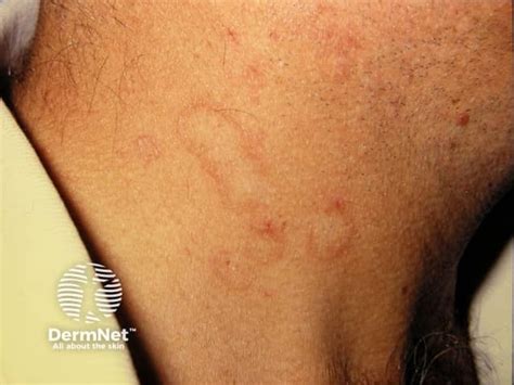 Elastolytic Giant Cell Granuloma Actinic Granuloma