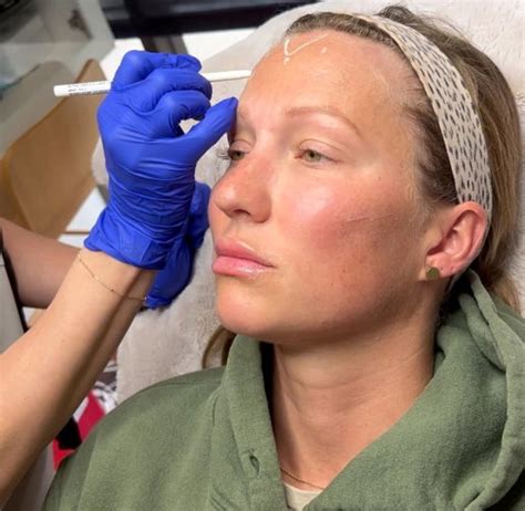 Is Masseter Botox Covered By Insurance Complete Guide