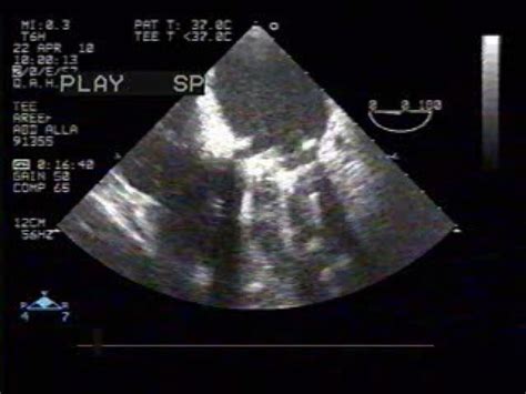 Adult Patient With Functioning Prosthetic Mitral Valve Without Ppt