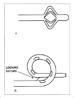 How The Percutaneous Nephrostomy Procedure Is Done Atrendynurse