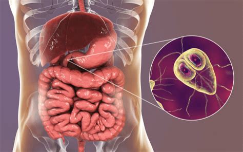 Giardiasis Symptoms Causes Complications And Remedies Factdr