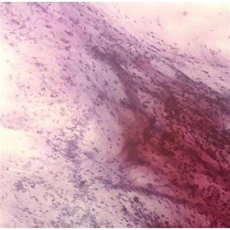 Bacteria Cover Squamous Cells With No Bacilli Clue Cells Download